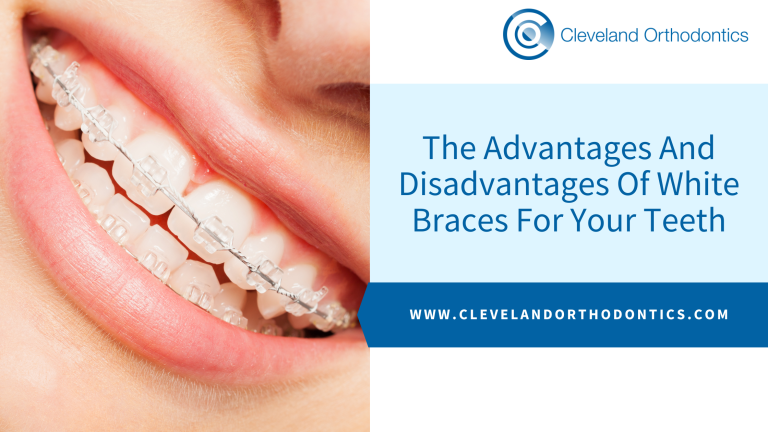 The Advantages And Disadvantages Of White Braces For Your Teeth ...