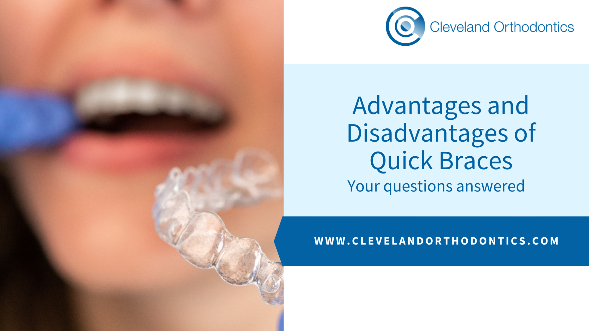 Advantages and Disadvantages of Quick Braces - Your Questions Answered ...