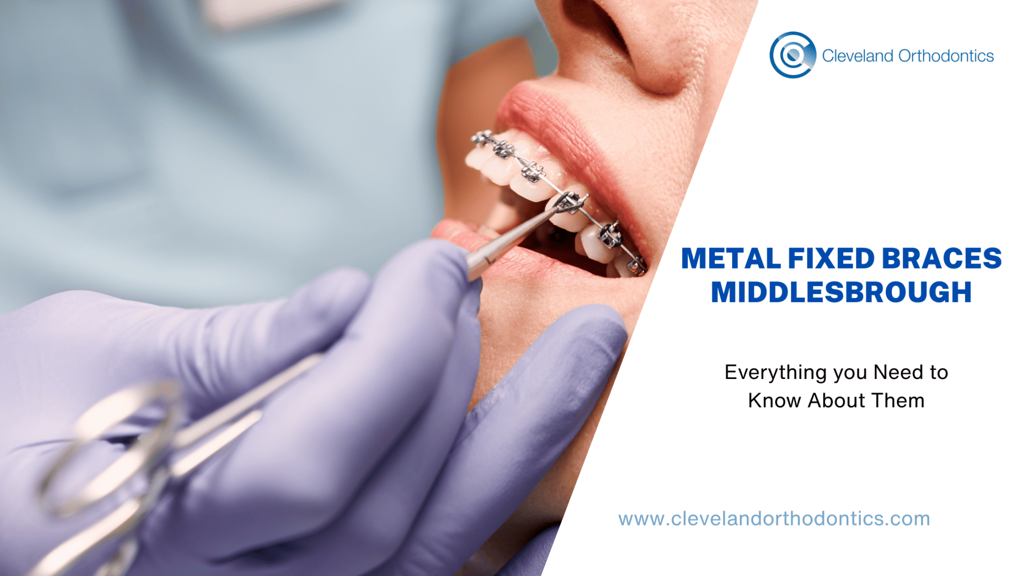 Metal Fixed Braces Middlesbrough: Everything You Need To Know About Them - Cleveland ...